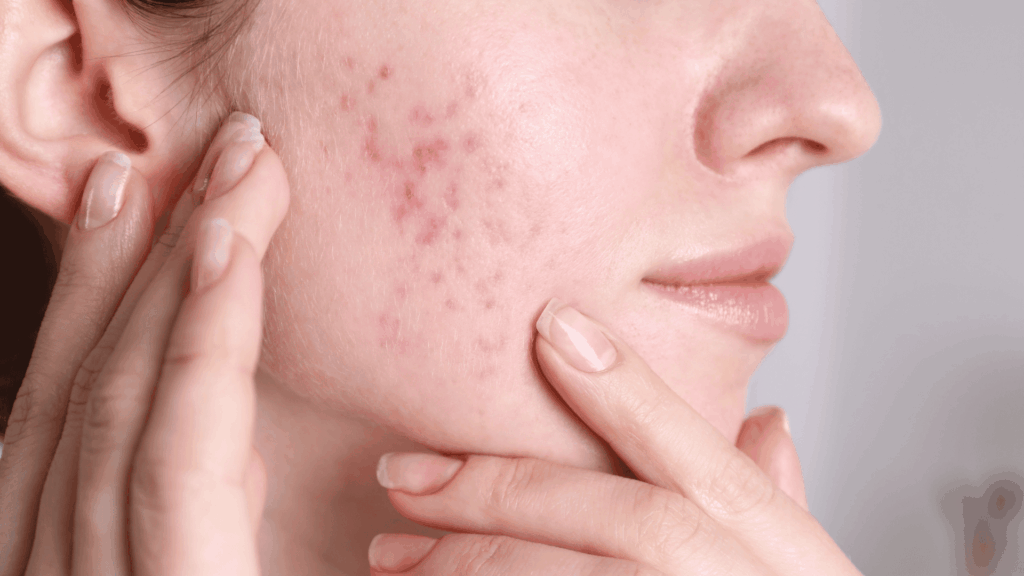 Acne Marks vs Scars: Know the Difference - LA Story