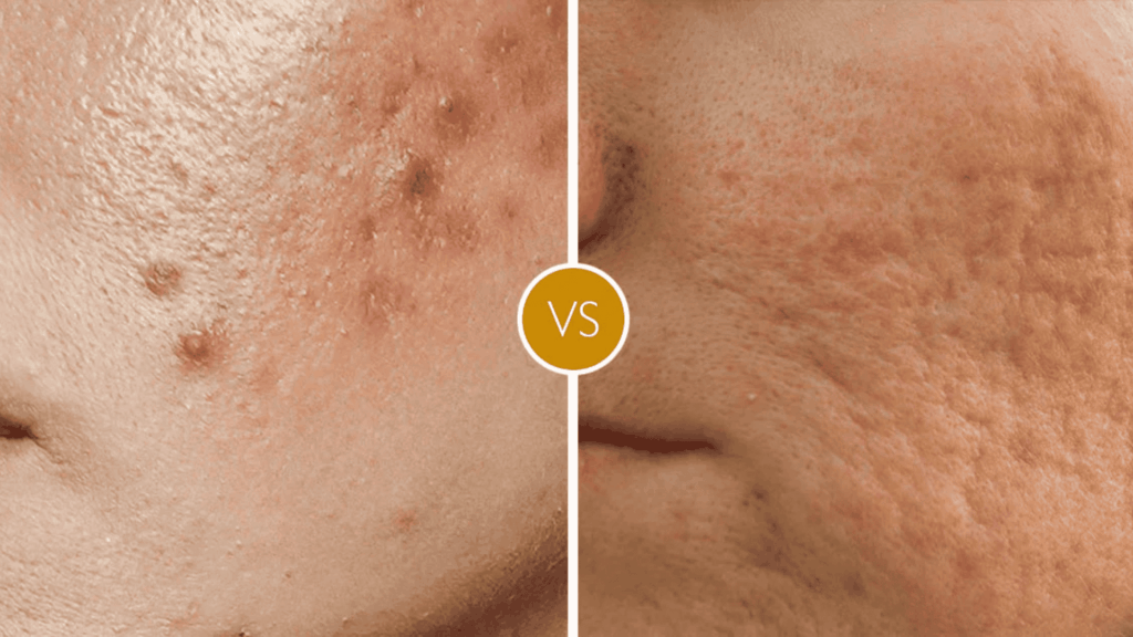 Acne Marks vs Scars: Know the Difference - LA Story