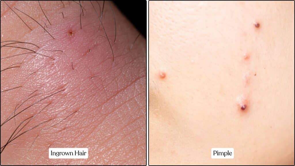 Ingrown Hair vs Pimple: Key Differences Explained - LA Story