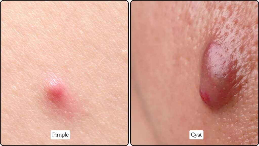 Pimple vs Cyst: Key Differences, Symptoms & Treatment - LA Story