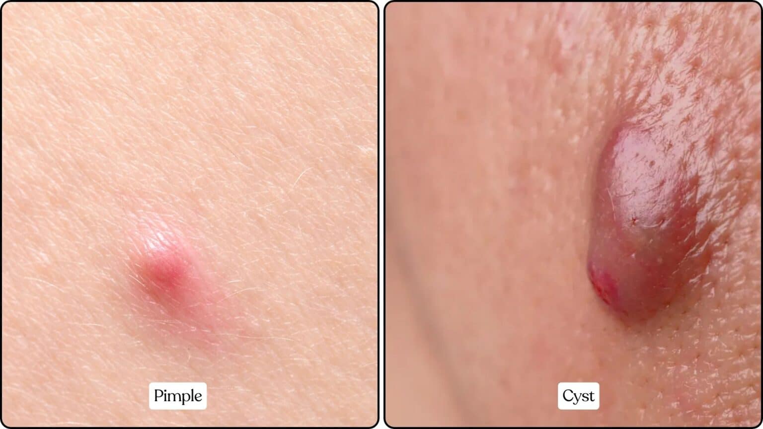 Pimple vs Cyst: Key Differences, Symptoms & Treatment - LA Story